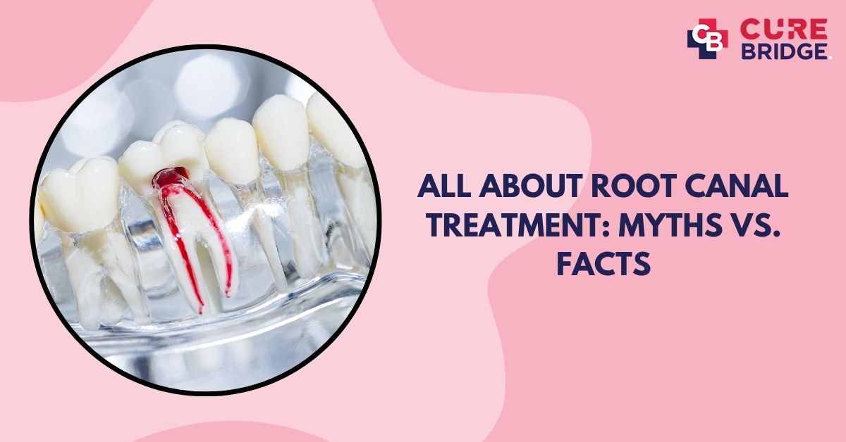 All About Root Canal Treatment: Myths vs. Facts